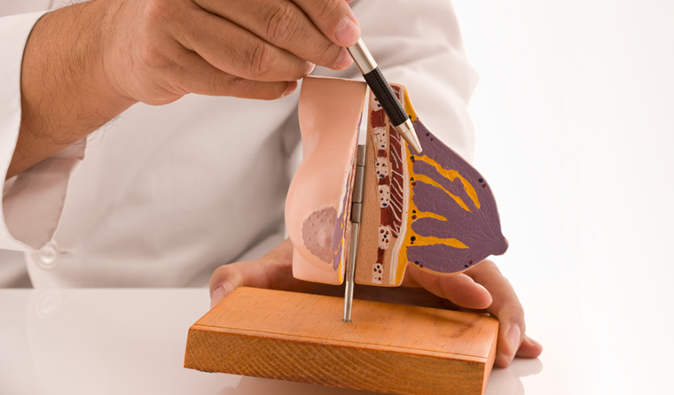 RACGP - Understanding breast cancer risk factors