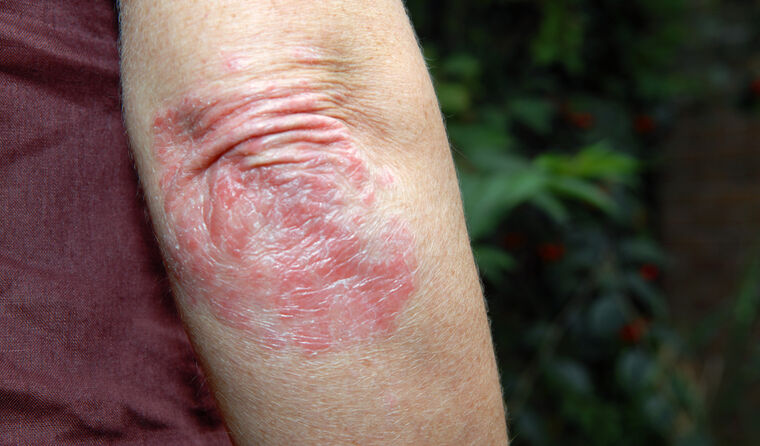 RACGP - PBS lists once-a-day pill for chronic psoriasis