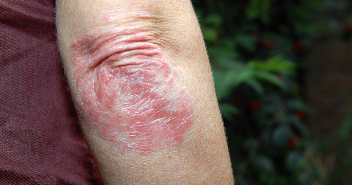 RACGP - PBS lists once-a-day pill for chronic psoriasis