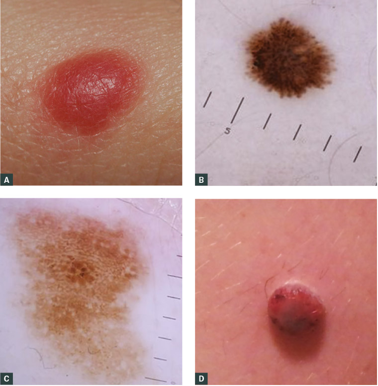 Racgp Benign Pigmented Skin Lesions Vrogue co Racgp Benign Pigmented Skin Lesions Vrogue co