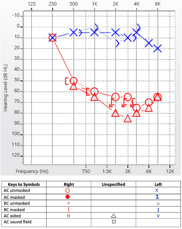 RACGP - Management of sudden sensorineural hearing loss