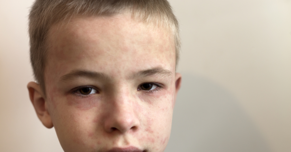 RACGP - Is measles making a comeback in Australia?