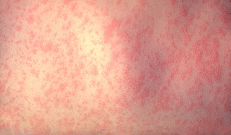 RACGP - Darwin measles outbreak ‘over’